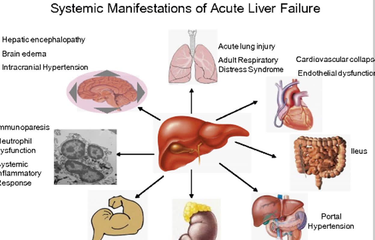 Quando o fígado está inchado, hepatomegalia, edema hepático, causas ...