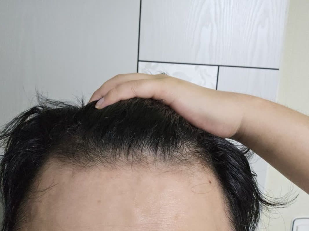 Frozen Lab'ın FGF7 olarak bilinen biotin saç klinik bileşeni Anagain Nu ...