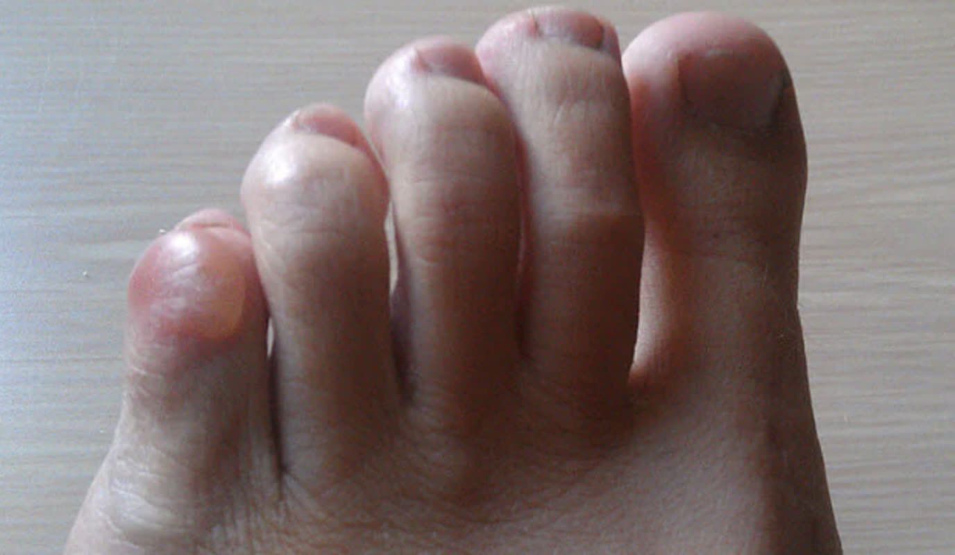Information about swollen little toes, swollen toes, causes and ...