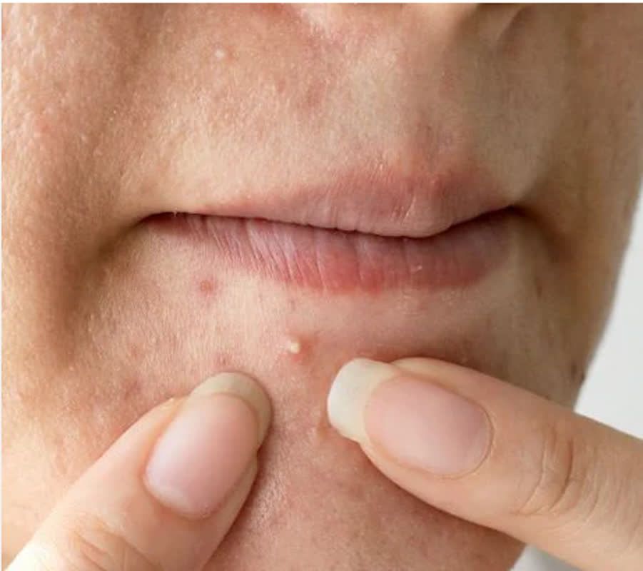 입술 뾰루지 입가에 여드름 혹 돌기 생기는 이유 9가지 각 증상 및 치료 관리 방법까지 | 건강한 삶을 리뷰하는 Heeee