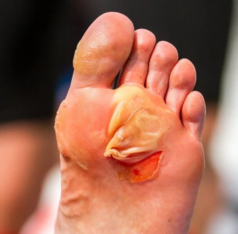 About blisters on your feet, blisters on your toes, causes, symptoms ...
